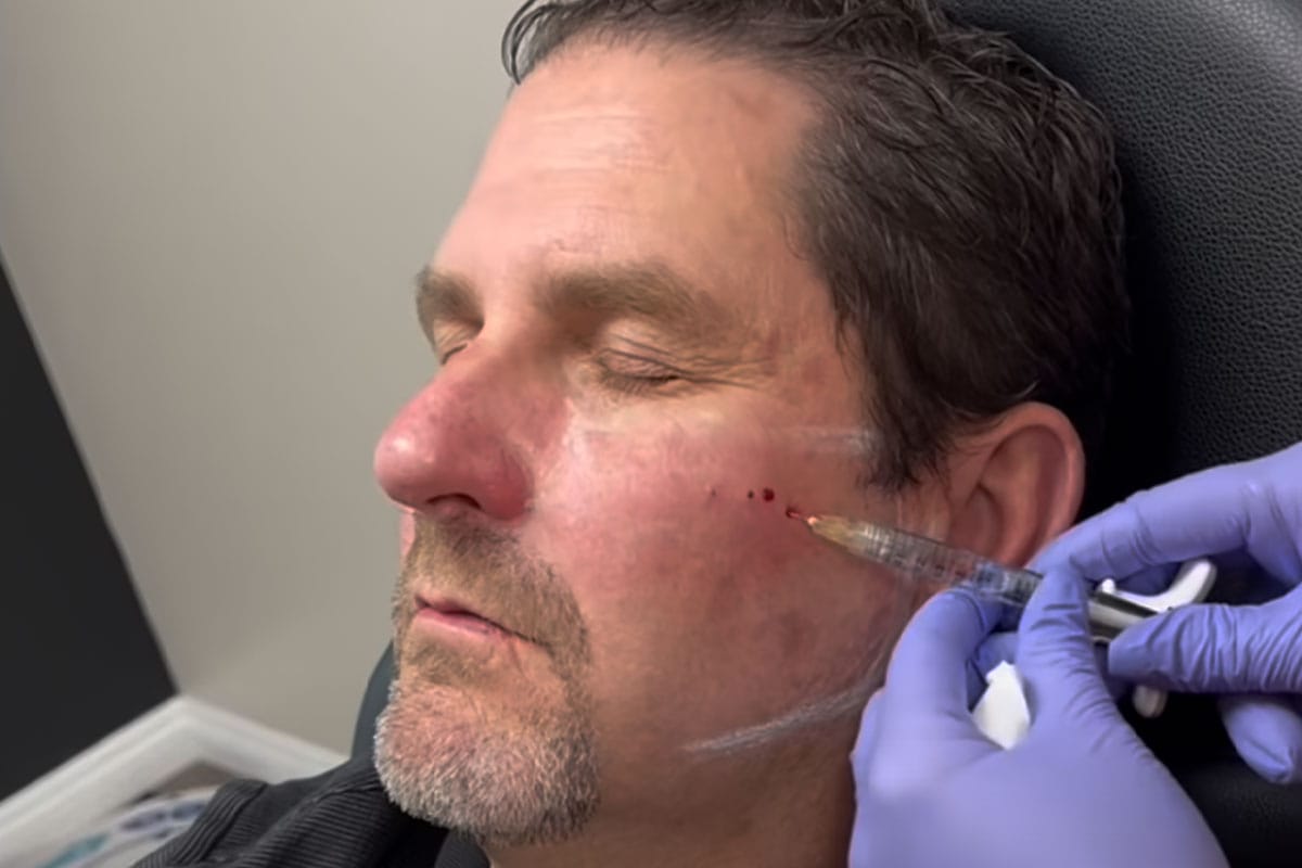 Juvéderm Volux XC in Redlands, CA | Natural Elegance Beauty