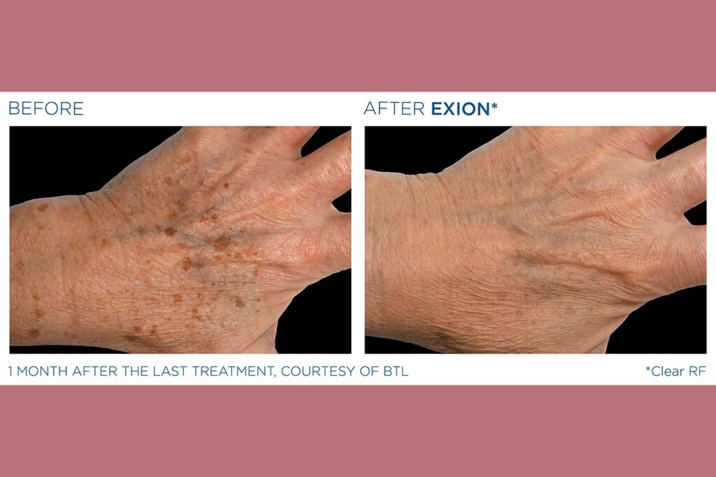 Discover the Power of Exion Clear RF: A Revolutionary Skin Resurfacing ...